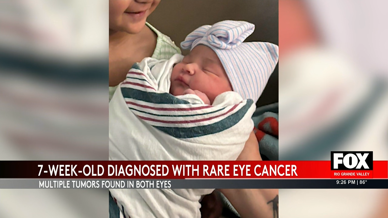 Houston: Alamo Family Seeks Community Support After Baby's Rare Eye ...